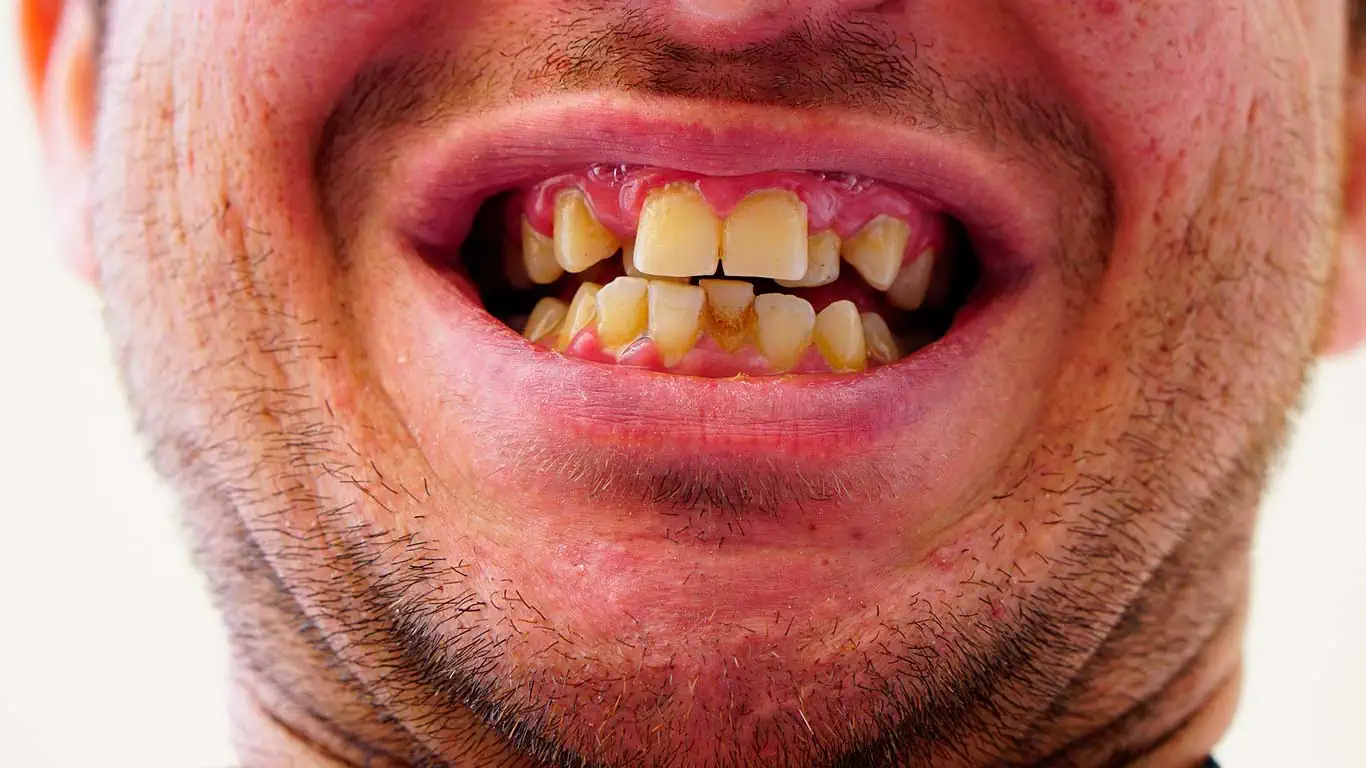 Prevenir y Corregir Dientes Torcidos Para Una Sonrisa Perfecta