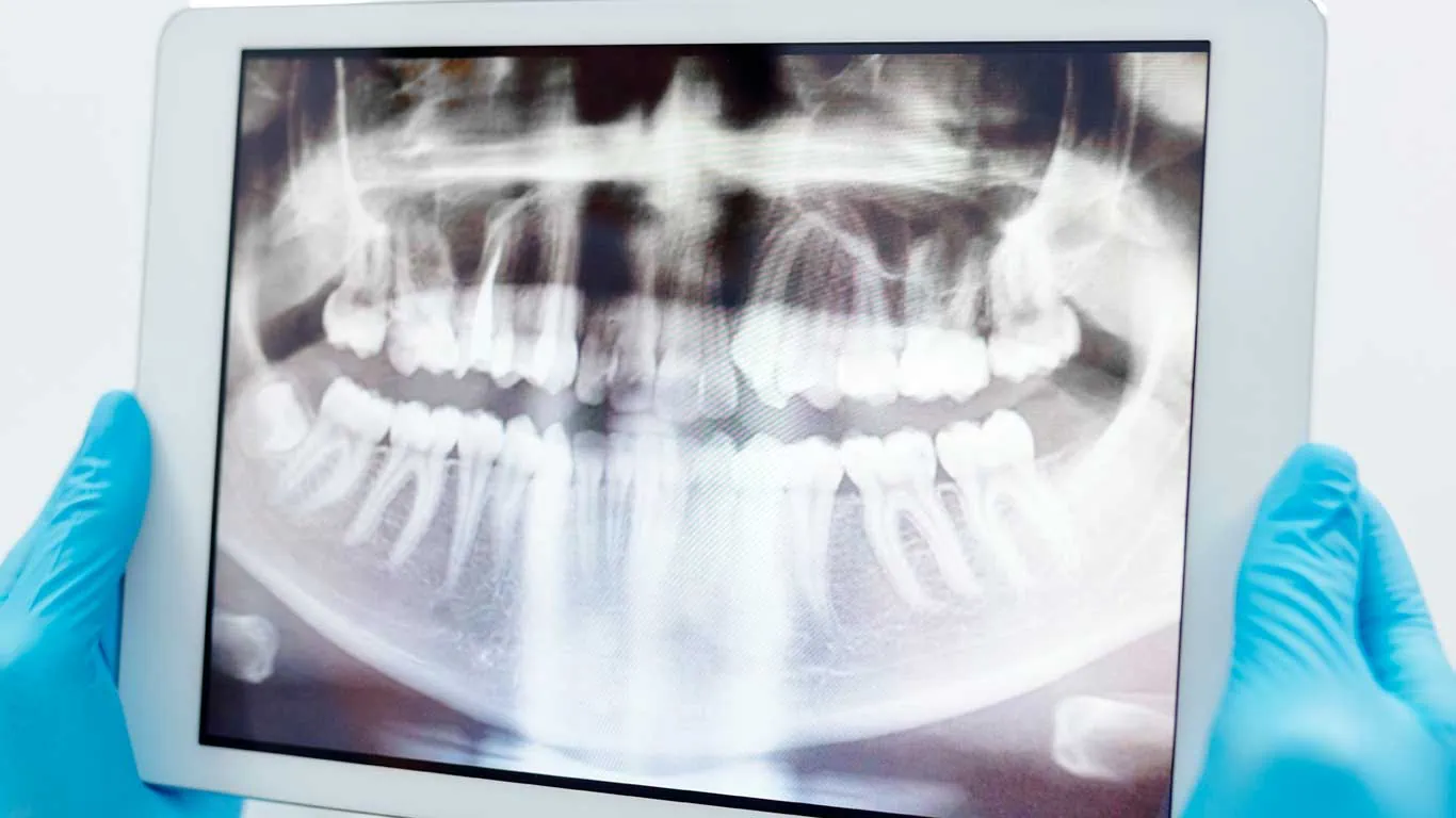 Los Dientes Supernumerarios - Clínica Dental Los Castellanos