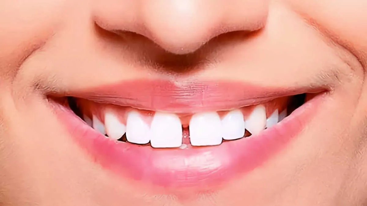 Diastema o Dientes Separados: Causas, Tratamientos